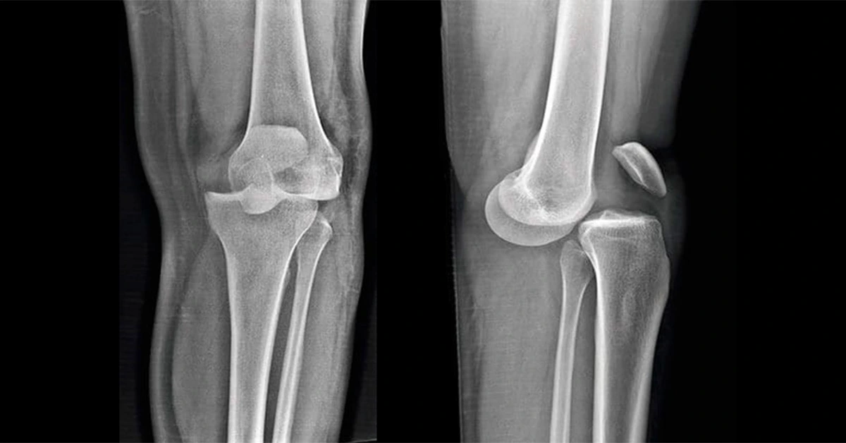 Luxación completa de rodilla | FisioAP